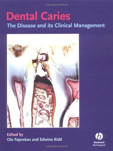 Dental Caries: The Disease and Its Clinical Management: Fejerskoy, Ole ...