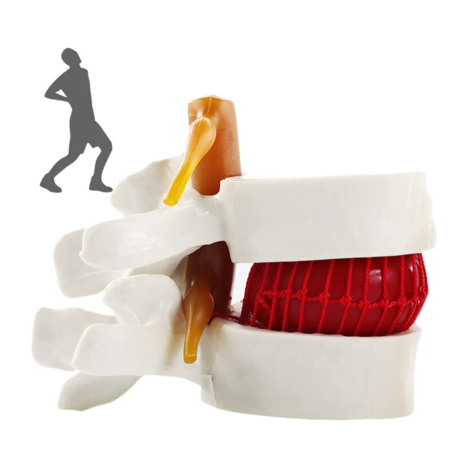 Buy Lumbar Disc Spine Anatomical Model, Human Lumbar Disc Herniation ...