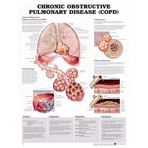 Chronic Obstructive Pulmonary Disease (COPD) Anatomical Chart Unmounted ...