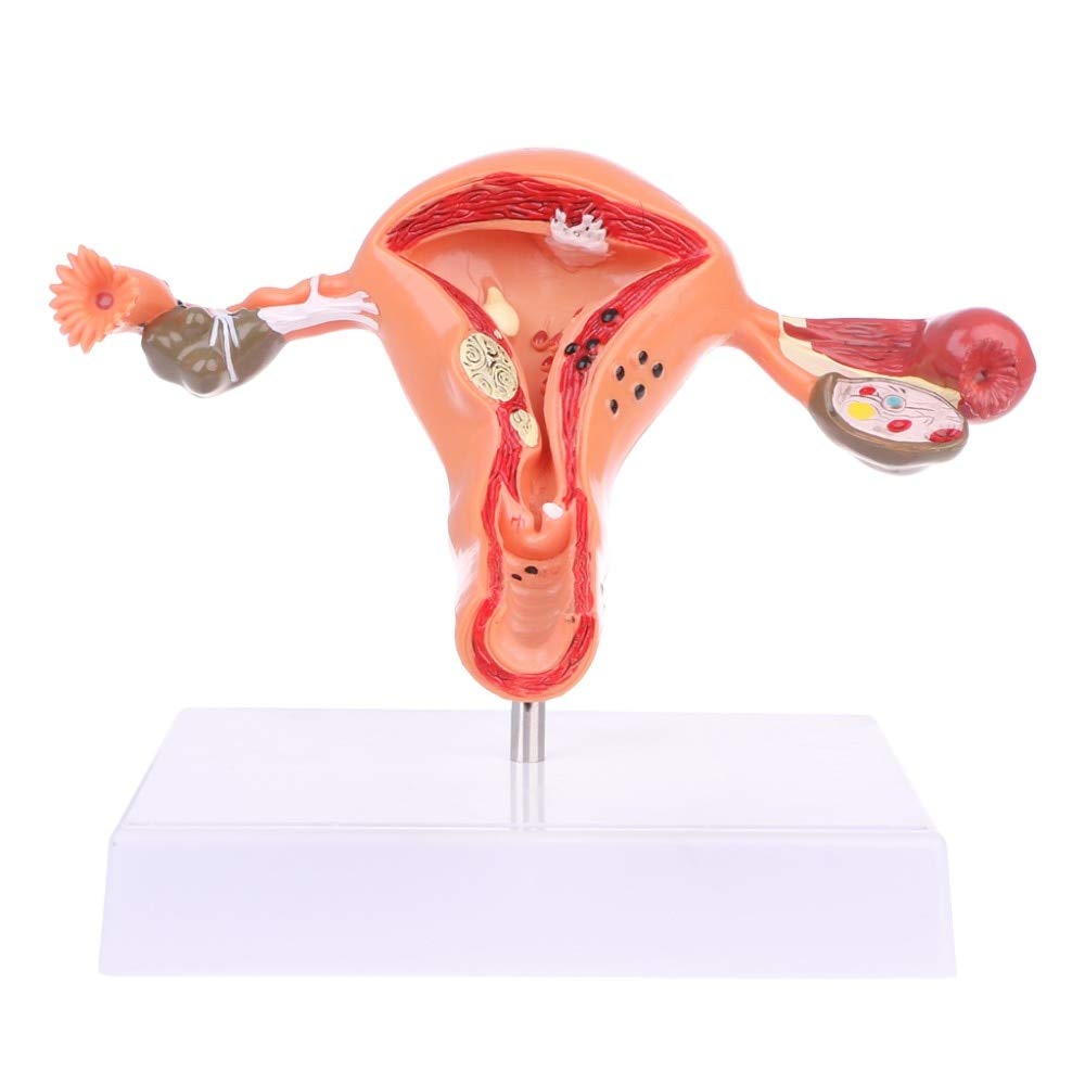 Buy GAOFQ Pathological Uterus Ovary Anatomical Model Anatomy Cross ...