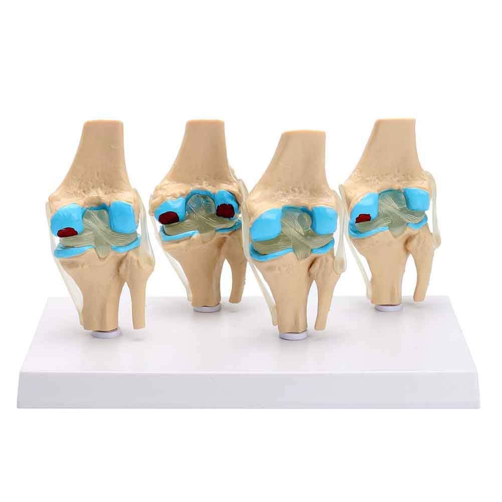 Buy BEZAX 4 Stage Human Knee Model - Joint Anatomy Model, Education ...