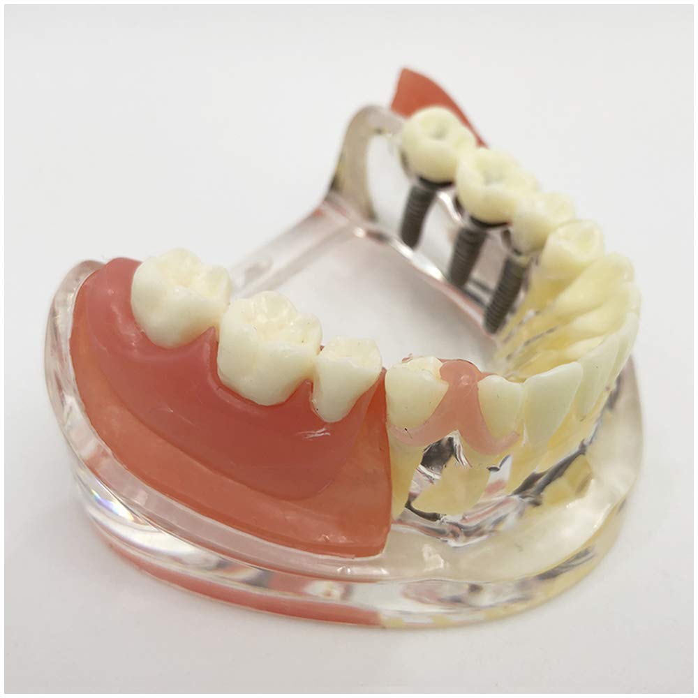 Buy Model Im Mandibular Im Restore Model with Removable Erase and ...