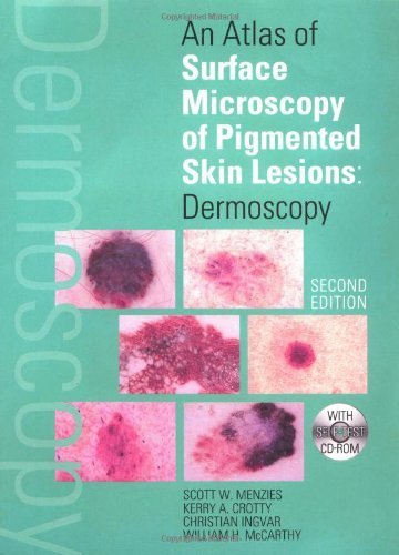 An Atlas of Surface Microscopy of Pigmented Skin Lesions: Dermoscopy ...