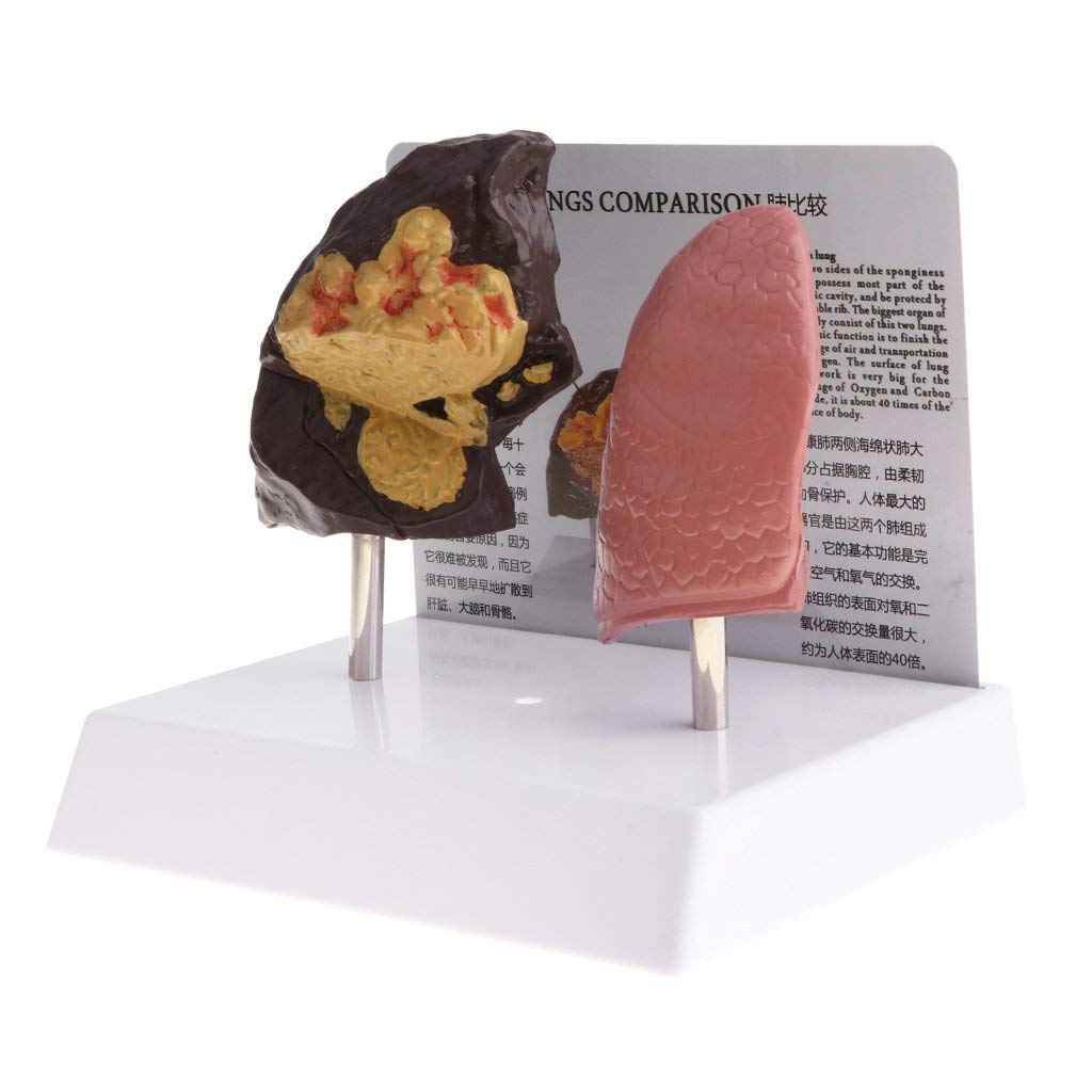 Buy QHYXT Pathological Lung y Lungs Comparative Model Organ Cut Section ...