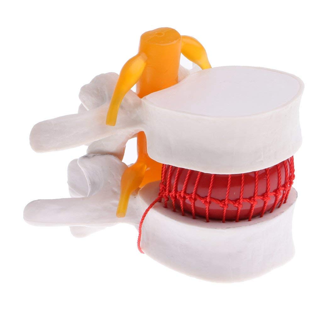 Lumbar Herniation Model Buy ZHANGYY Human Lumbar , Anatomical Human ...