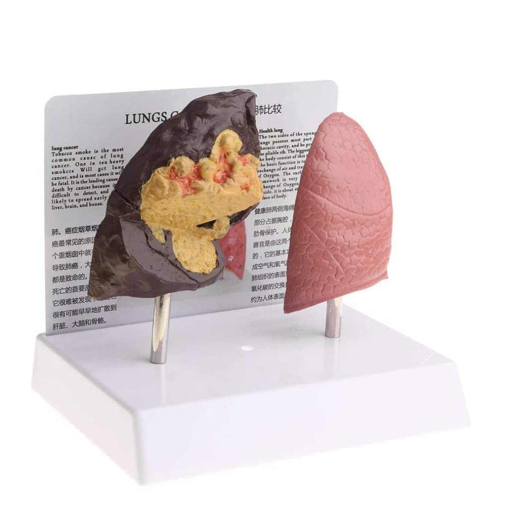 Smokers Lung Comparison