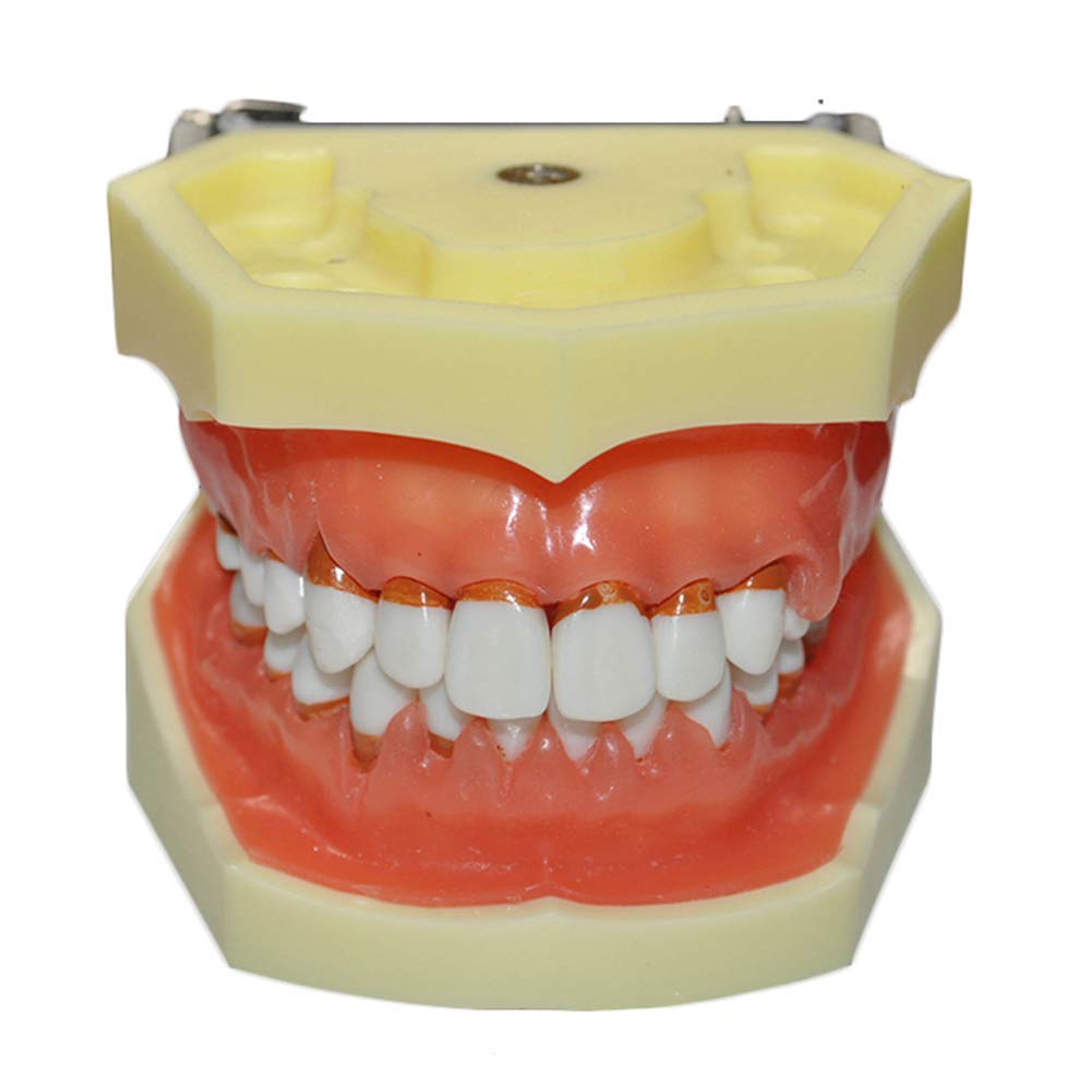 Buy FSFF Dental Typodont Model - Periodontal Disease Teeth Model ...