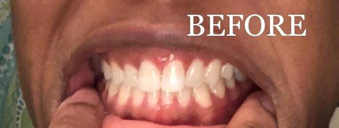 Amazon.com : POPWHITE Purple Power Duo Natural Teeth Whitening with 4 ...