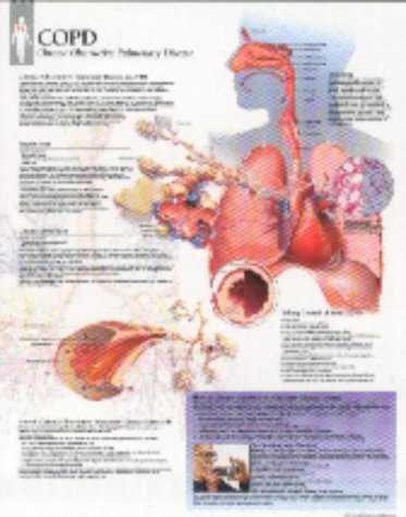 COPD chart: Laminated Wall Chart: Laminated Wall Chart: Scientific ...