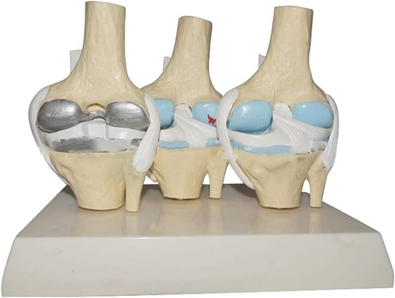 WDSOPK Human Knee Model Stages Of Lesions Knee Model Joint Anatomy ...