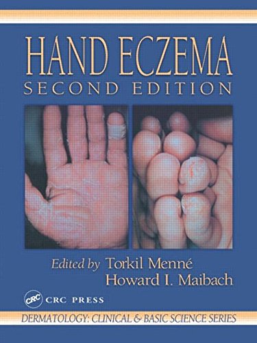 Hand Eczema: Amazon.co.uk: Menne, Torkil, Maibach, Howard I ...