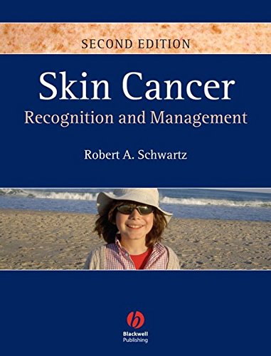 Skin Cancer: Recognition and Management eBook : Amazon.co.uk: Books