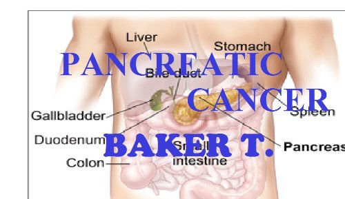 Amazon.com: Pancreatic Cancer (WHAT YOU NEED TO KNOW Book 6) eBook : T ...