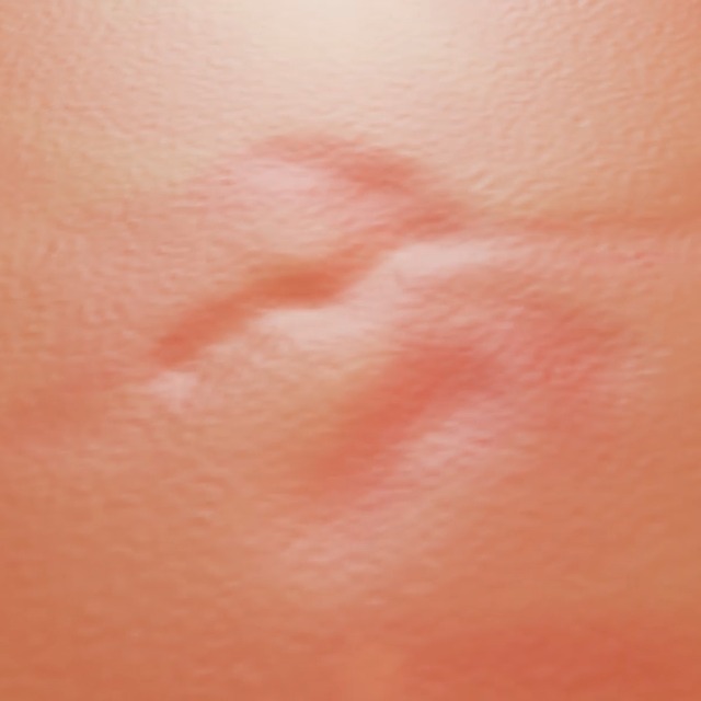 Watch Particle Scar Gel Before and After on Amazon Live