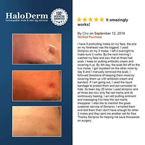 HaloDerm Skin Tag Remover & Mole Remover - All Natural Skin Tag Cream ...