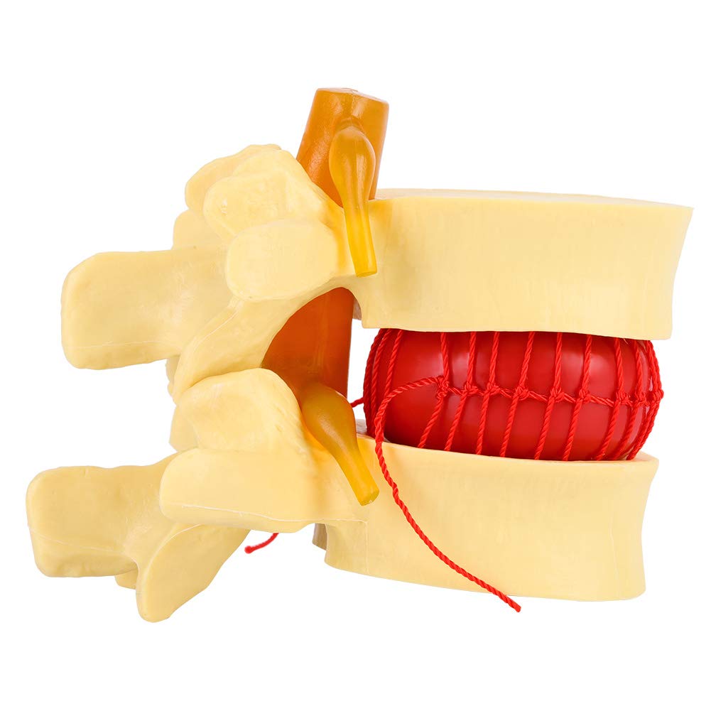 Disc Herniation Model Human Lumbar Demonstration Model Of Lumbar Lumbar ...