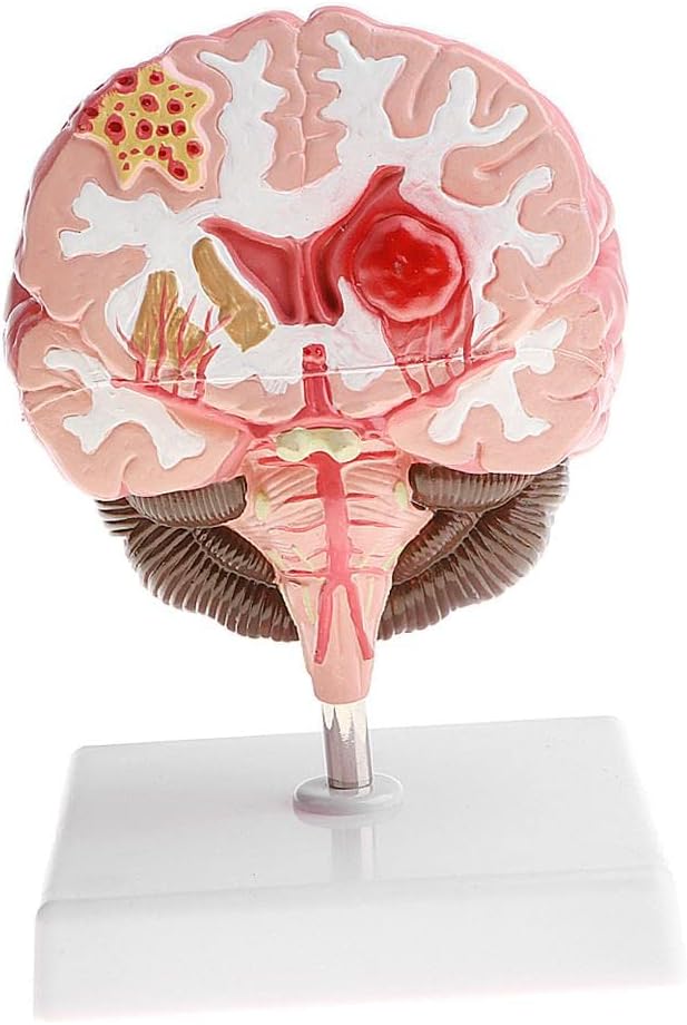 Amazon.com: Jojomis Human Brain Pathology Anatomical Tools Model ...