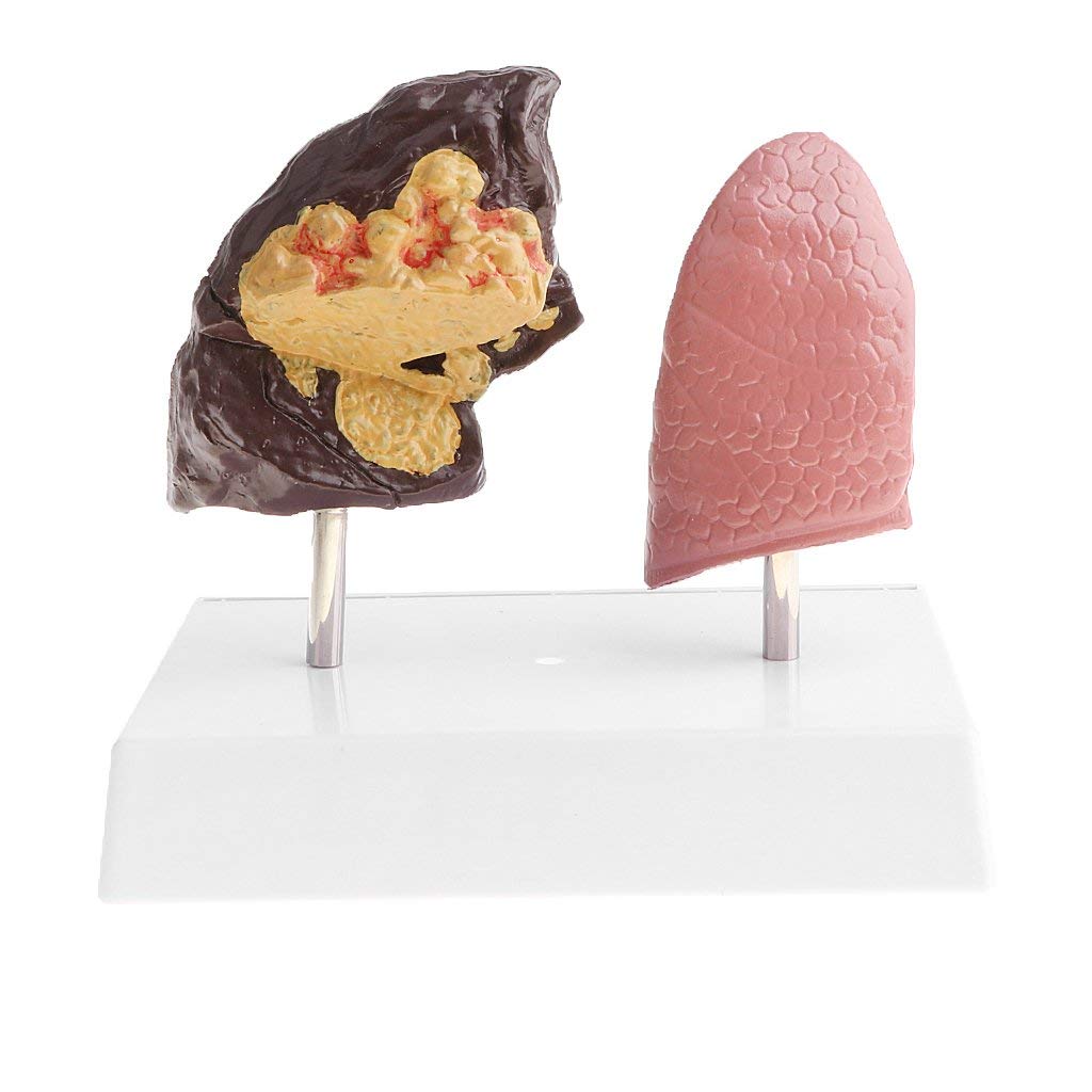 Buy Lung Anatomy Model, Smoker's Lungs Vs Normal Lung,y Lungs for ...