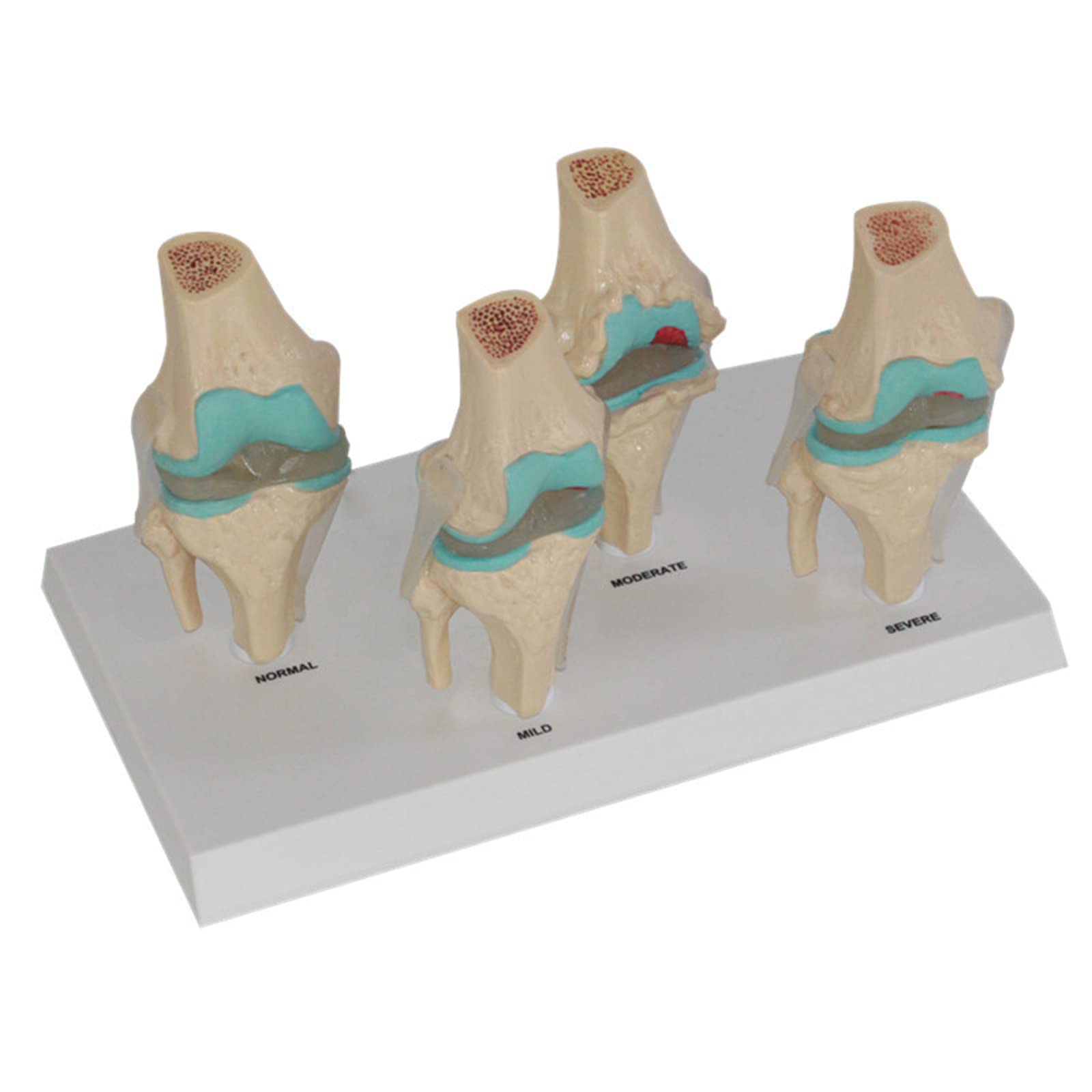 Buy Human Knee Joint Model, Four Stages of Human Anatomy Knee Joint ...