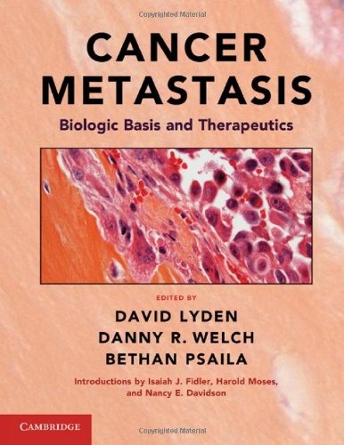 Cancer Metastasis: Biologic Basis and Therapeutics : Lyden, David ...