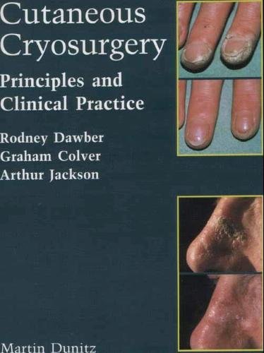Cutaneous Cryosurgery: Principles and Clinical Practice: 9781853170829 ...