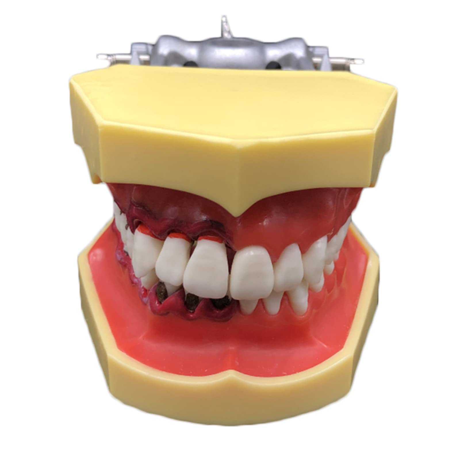 Buy K99 Typodont Study Teaching Model Dental Periodontal Disease Assort ...