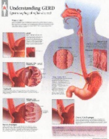 Understanding GERD chart: Wall Chart: 9781930633209: Medicine & Health ...