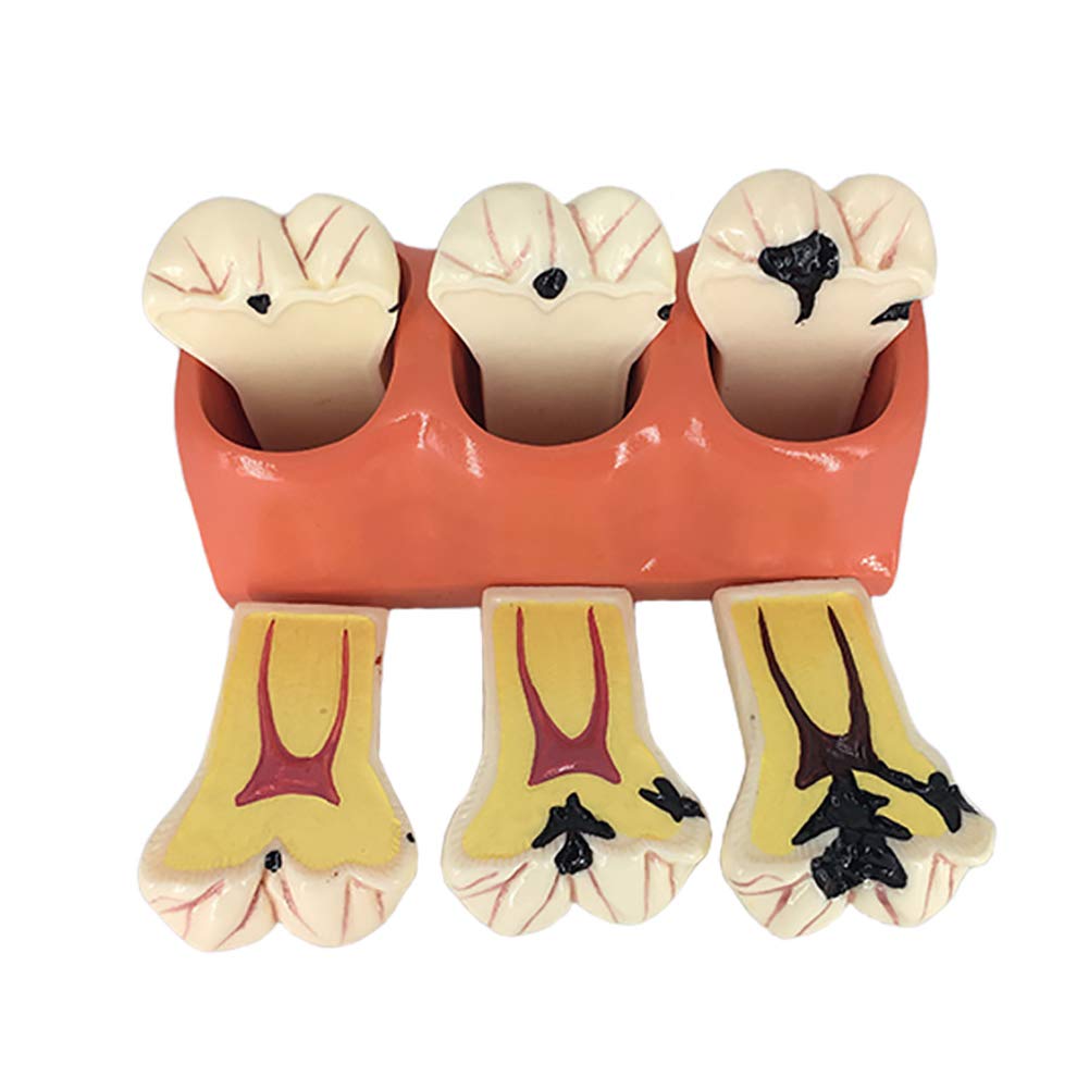 Buy Tooth cavity model, 4X oral teaching patient communication model ...