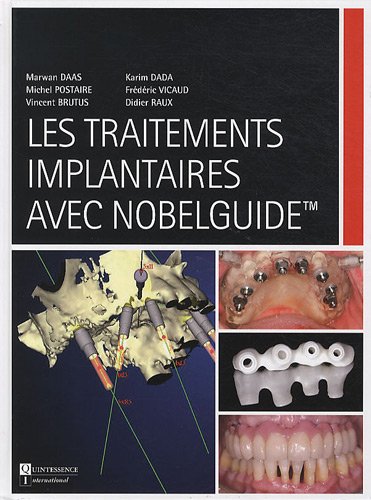 Les Traitements Implantaires Avec Nobelguide : Daas, Marwan, Dada ...