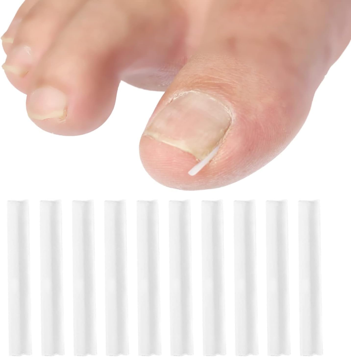 Amazon.com: BEZOX Ingrown Toenail Corrector Set - 40 Pcs Pain-Free ...