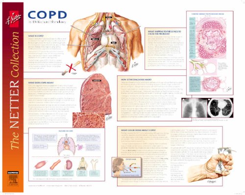 Buy Frank H. Netter Chronic Obstructive Pulmonary Disease Poster ...