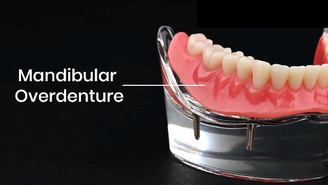 Dentures For Women IDENTical Mandibular Overdenture Model With 4 ...