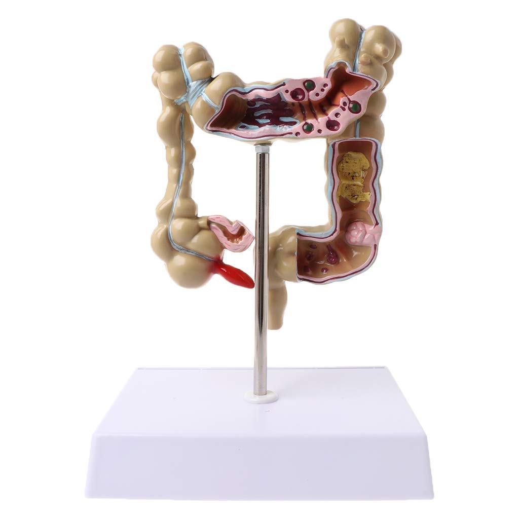 Buy Colon Human Anatomical Model with Pathologies, Human Colorectal ...