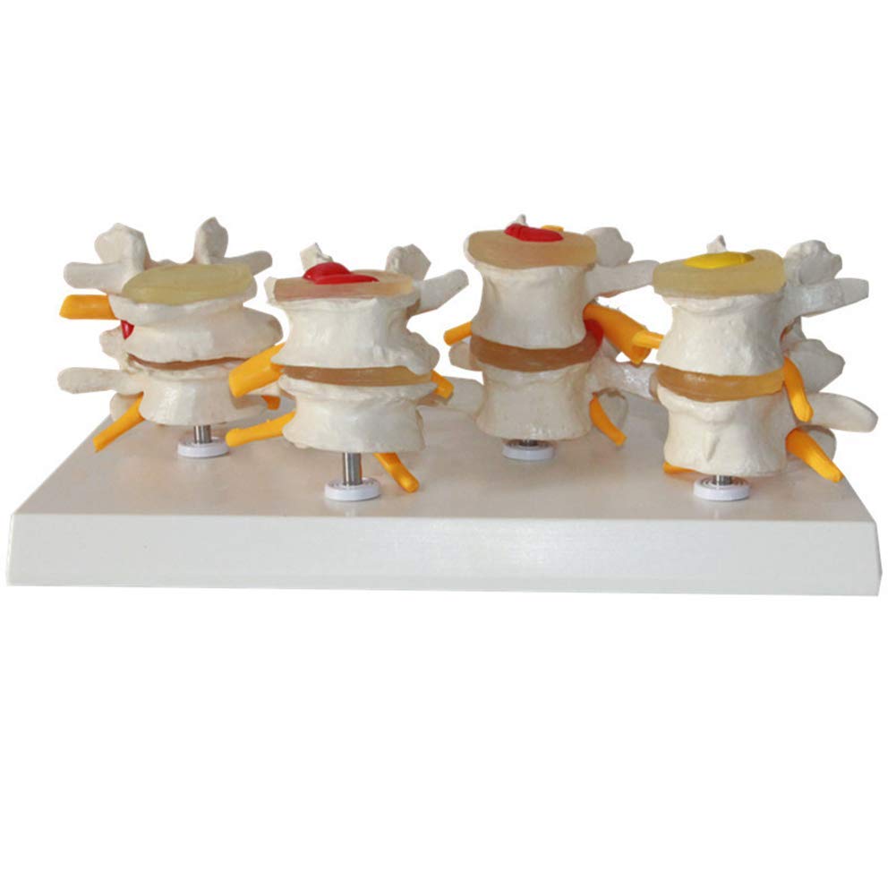 Buy Four Stages of Human Lumbar Spine Disease Model-Disc Herniation ...