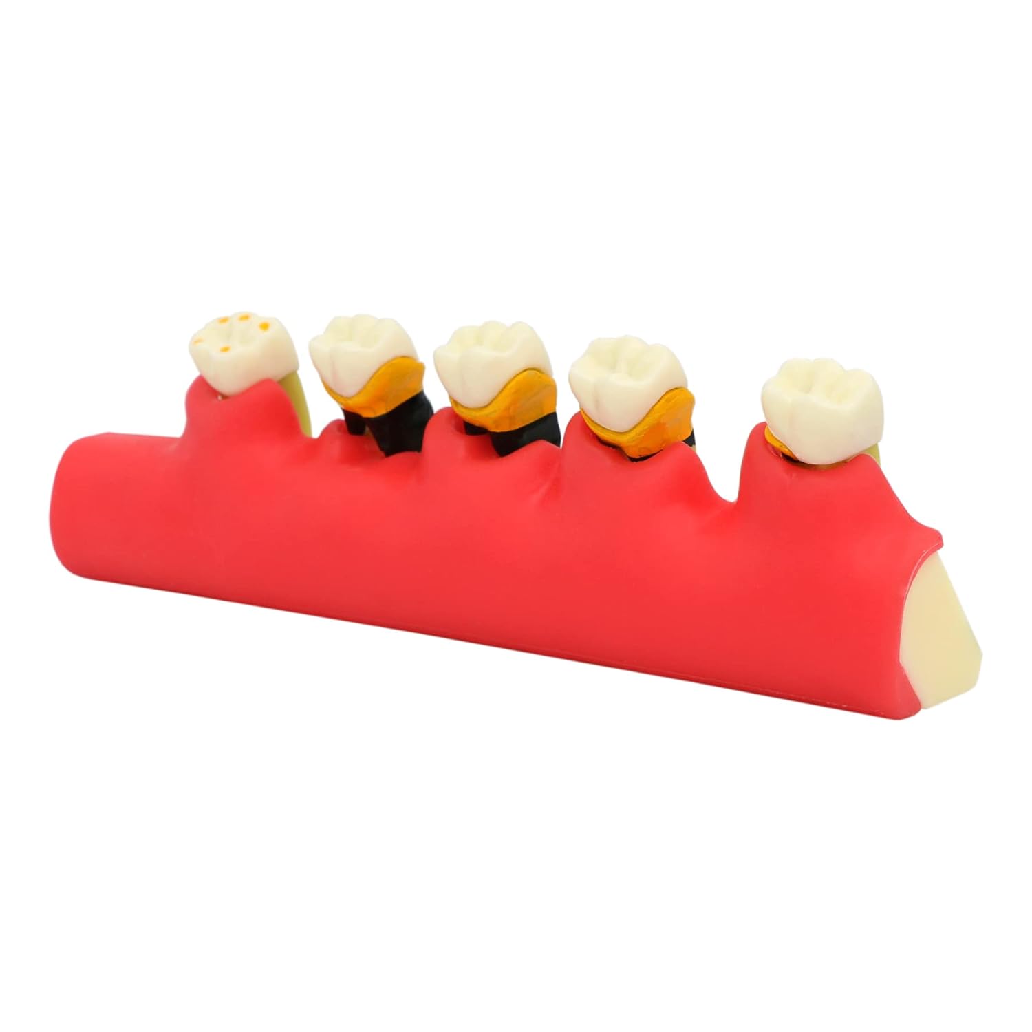 Teeth Periodontal Disease Model Dental Caries Nepal | Ubuy