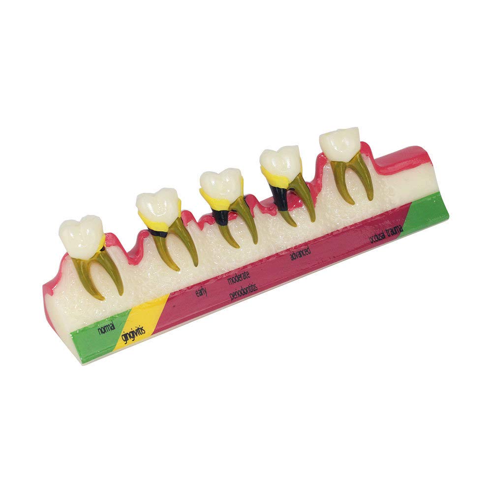 Buy Oral Dental Model, Oral Periodontal Disease Classification Model ...