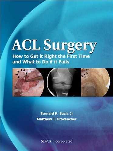 ACL Surgery: How To Get It Right the First Time and What To Do if it Fails (Bach, ACL Surgery ...