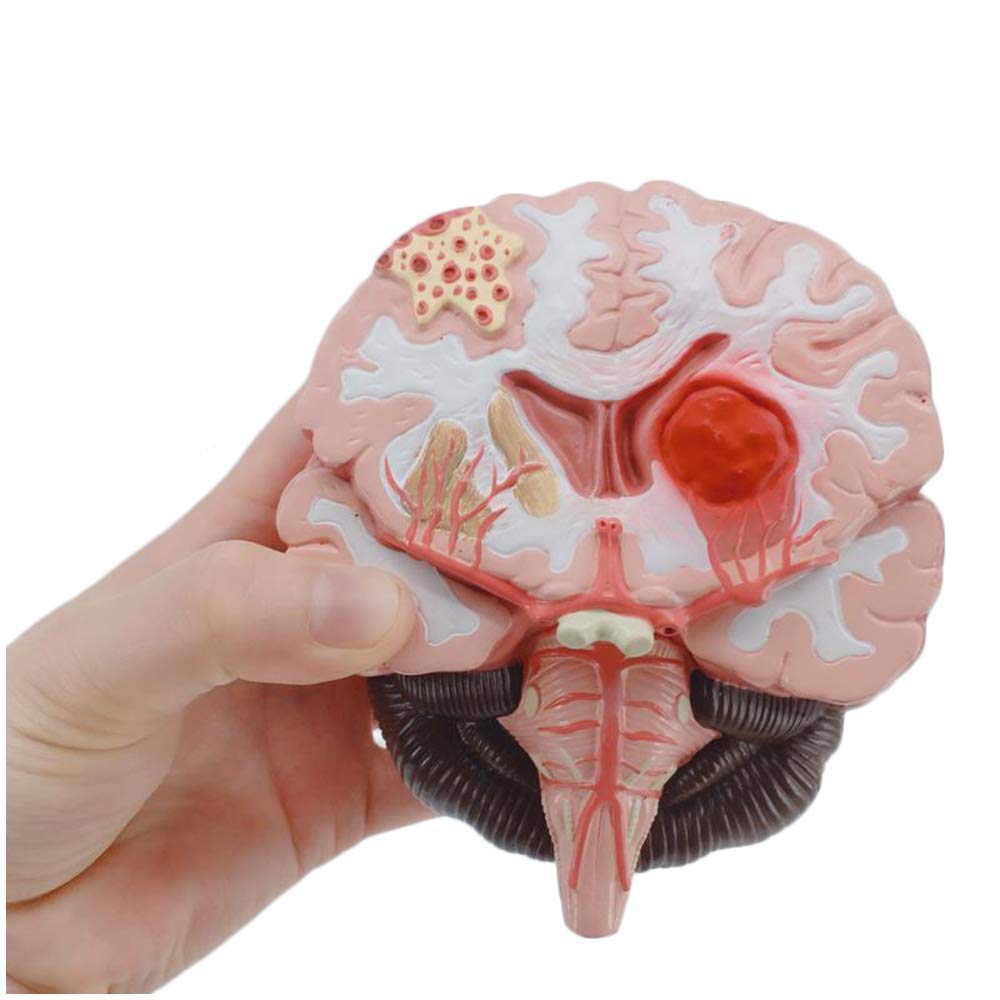 Buy Educational Model Anatomical Brain Model - Malformed Brain ...