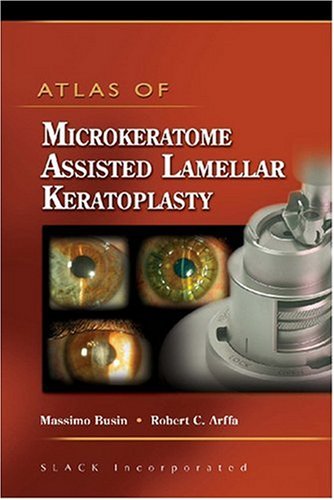 Amazon | Atlas of Microkeratome Assisted Lamellar Keratoplasty | Busin ...