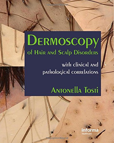 Buy Dermoscopy of Hair and Scalp Disorders: With Clinical and ...
