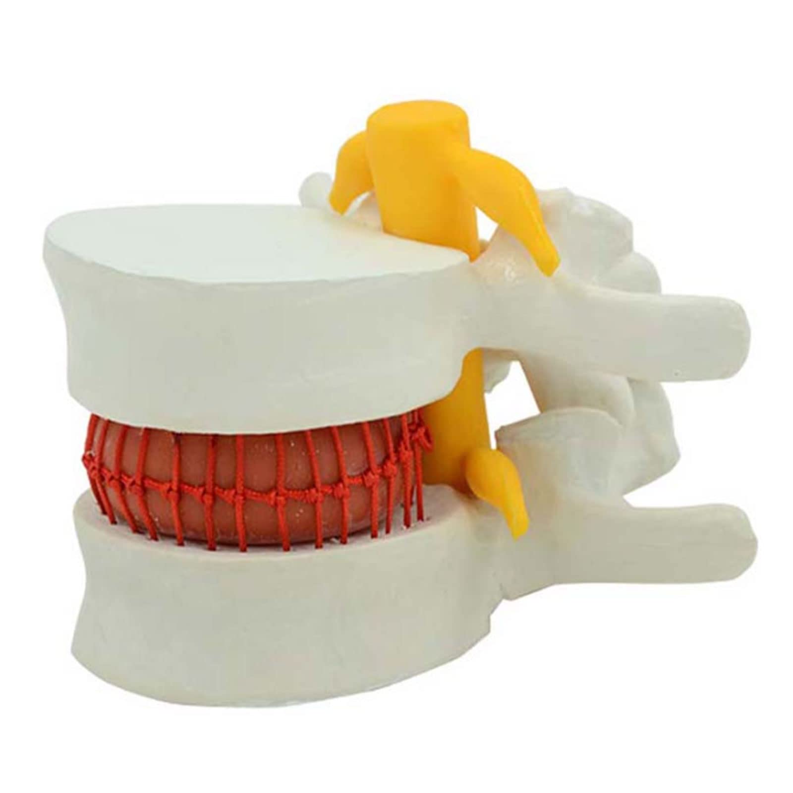 Buy Lumbar Vertebrae Model Anatomical Spine Lumbar Disc Herniation ...