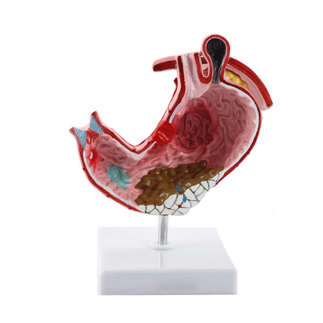 Xsxq Human Stomach Anatomy Model Pathological Stomach Demonstration ...