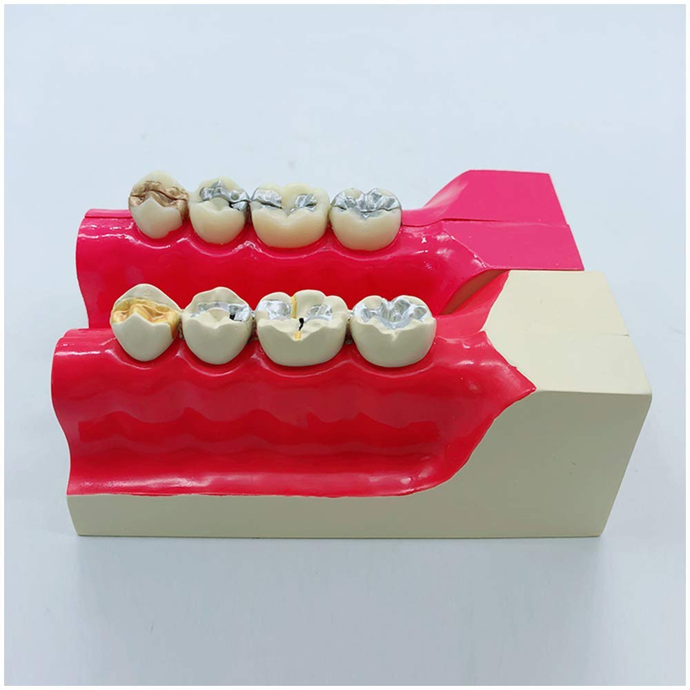 Tooth Template 2pcs Dental Molar Cross Section Template Of Model ...