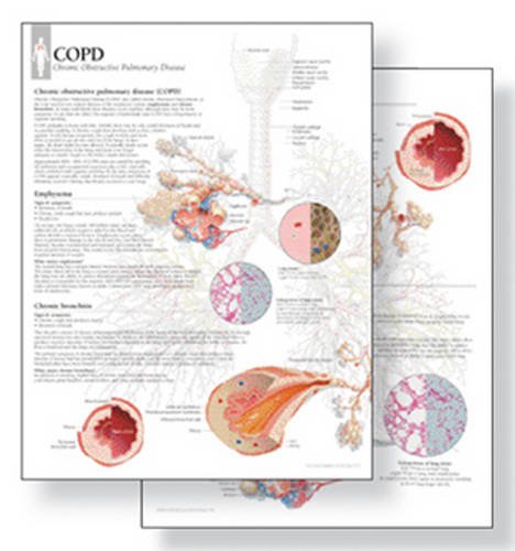 Buy Understanding COPD Study Set Replacement Pads: Patient Education Study Sets Book Online at ...