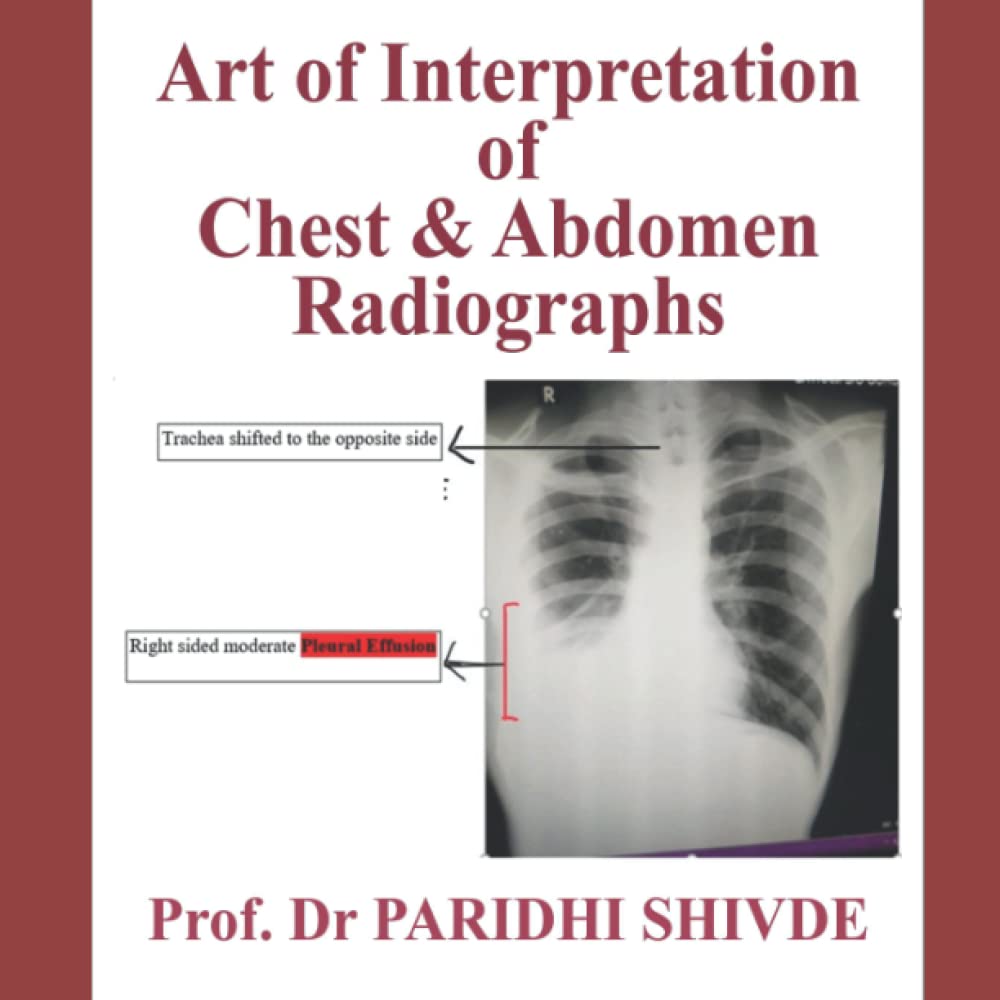 Buy ART OF INTERPRETATION OF CHEST AND ABDOMEN RADIOGRAPHS Online at ...