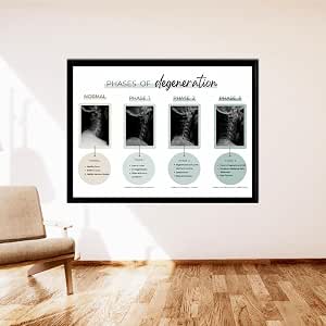 Amazon.com: Phases Of Degeneration Poster, Progression Of Degeneration ...