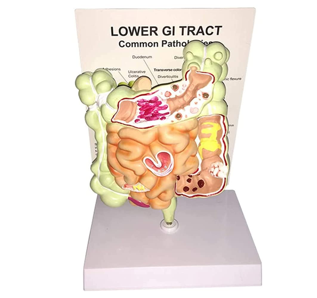 Laerper Teaching Model Human Large Intestine Pathology Model Human ...