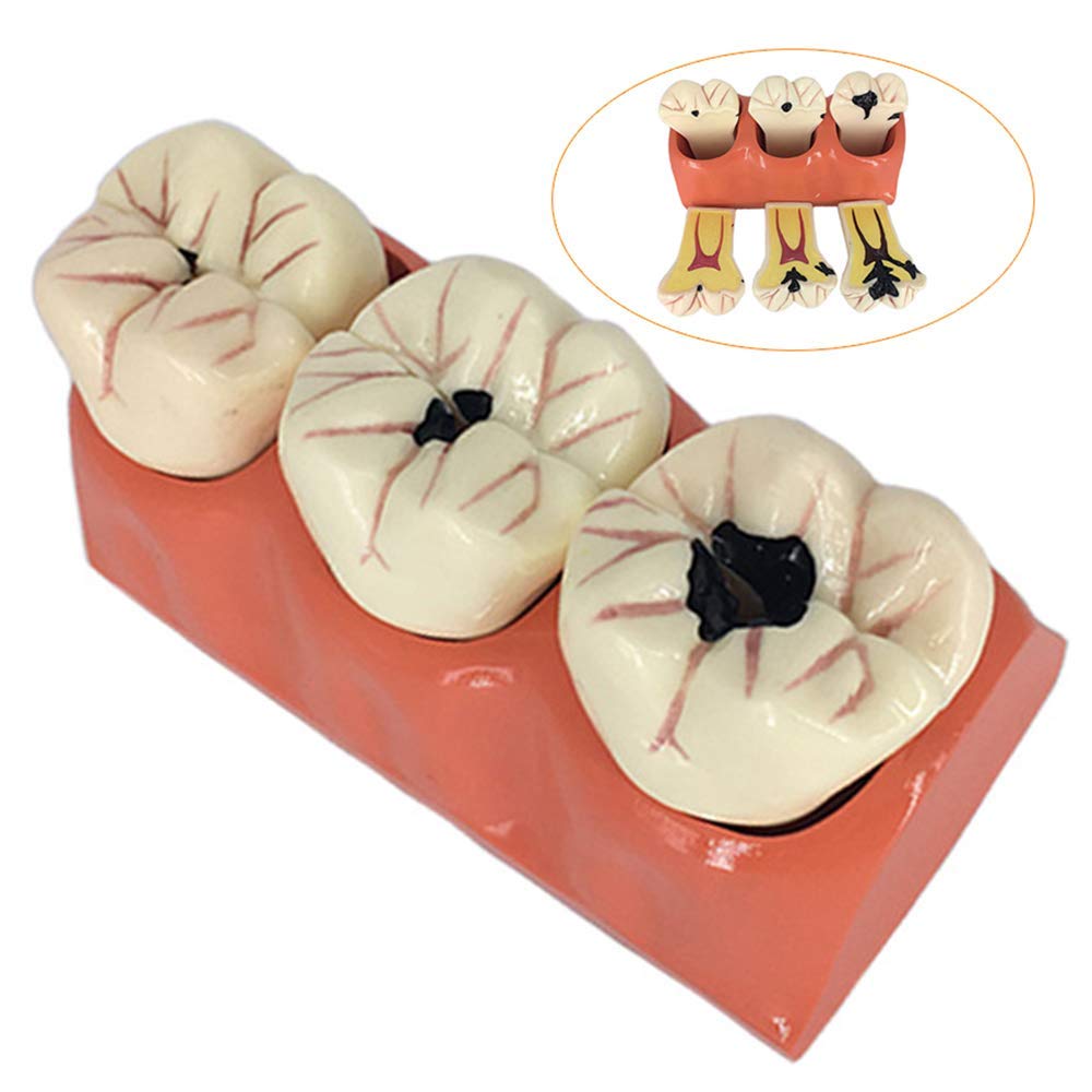 Buy Nfudishpu Tooth Model Im Analysis Crown Bridge Demonstration Dental ...