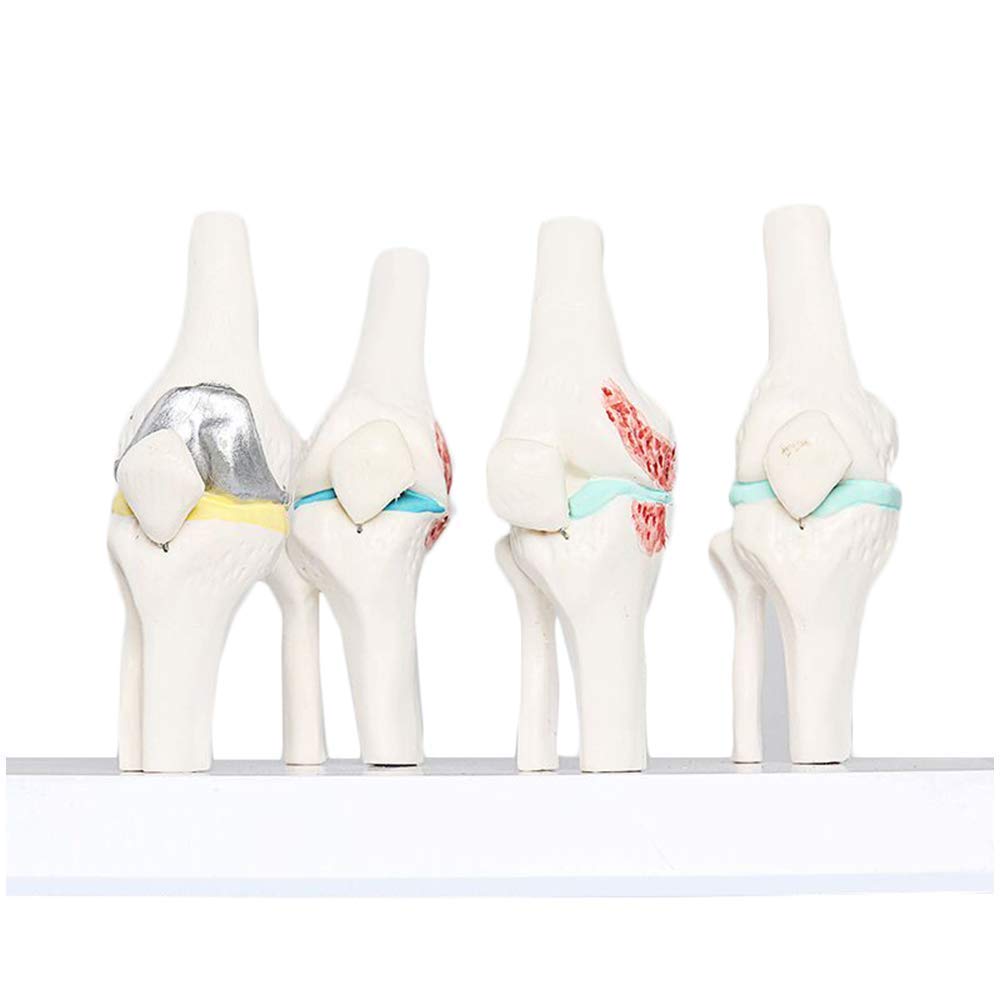 Buy DYTAH Knee Joint Model Human Body Anatomy Replica Set of 4-Stage ...