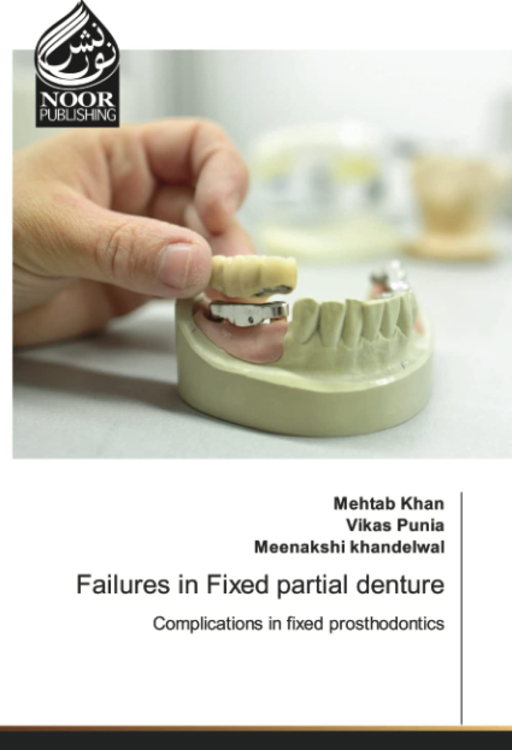 Failures in Fixed partial denture : Amazon.in: Books
